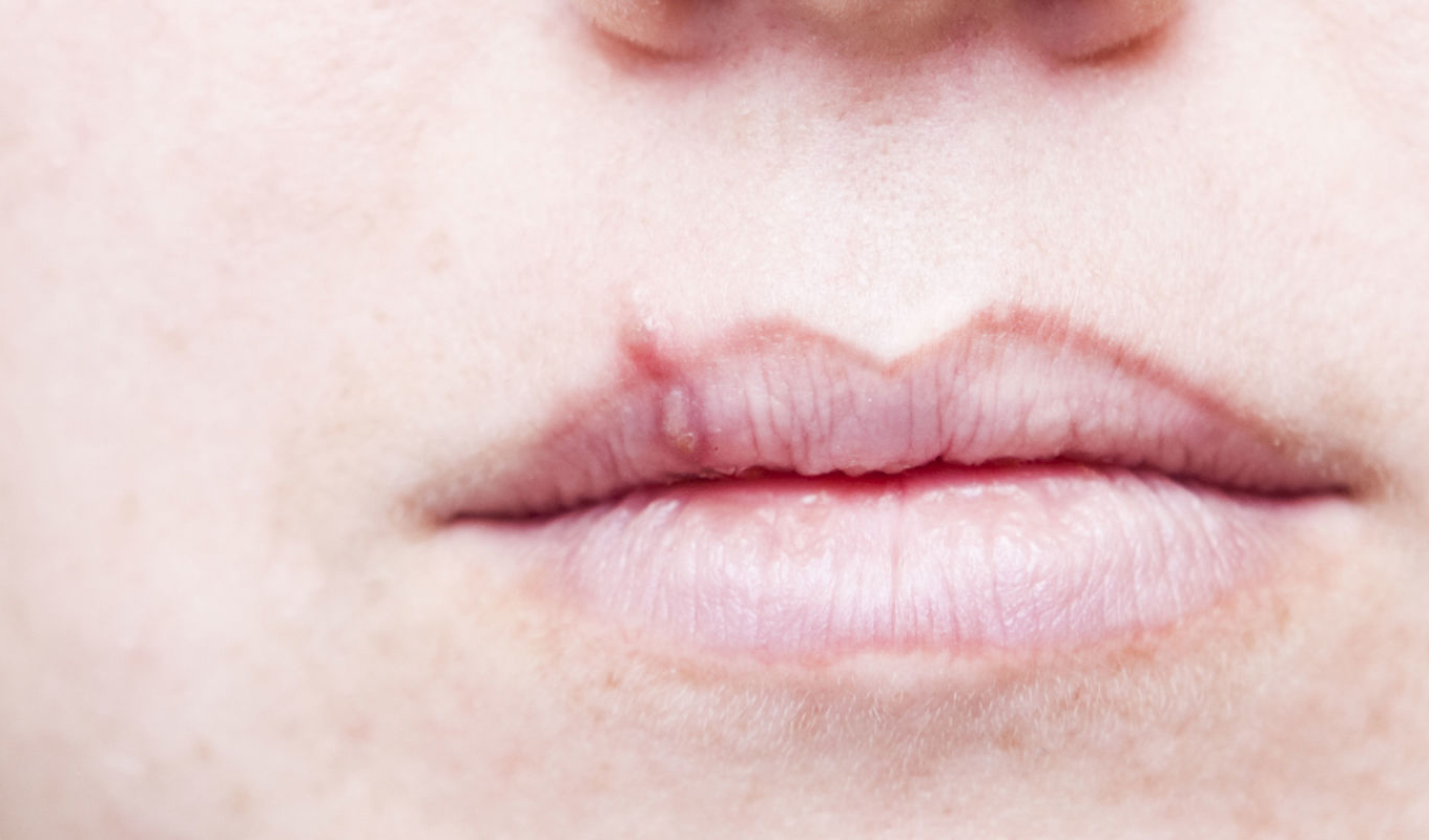 Fed Up With A Nasty Pimple On Lip Fed Up With A Nasty Pimple On Lip