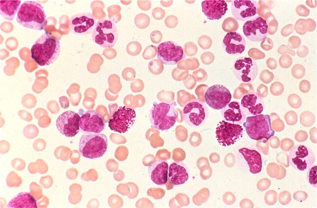 Acute Leukemia Symptoms and Little Known Facts