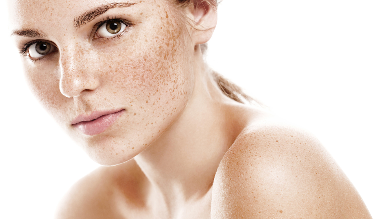 What Causes Freckles?